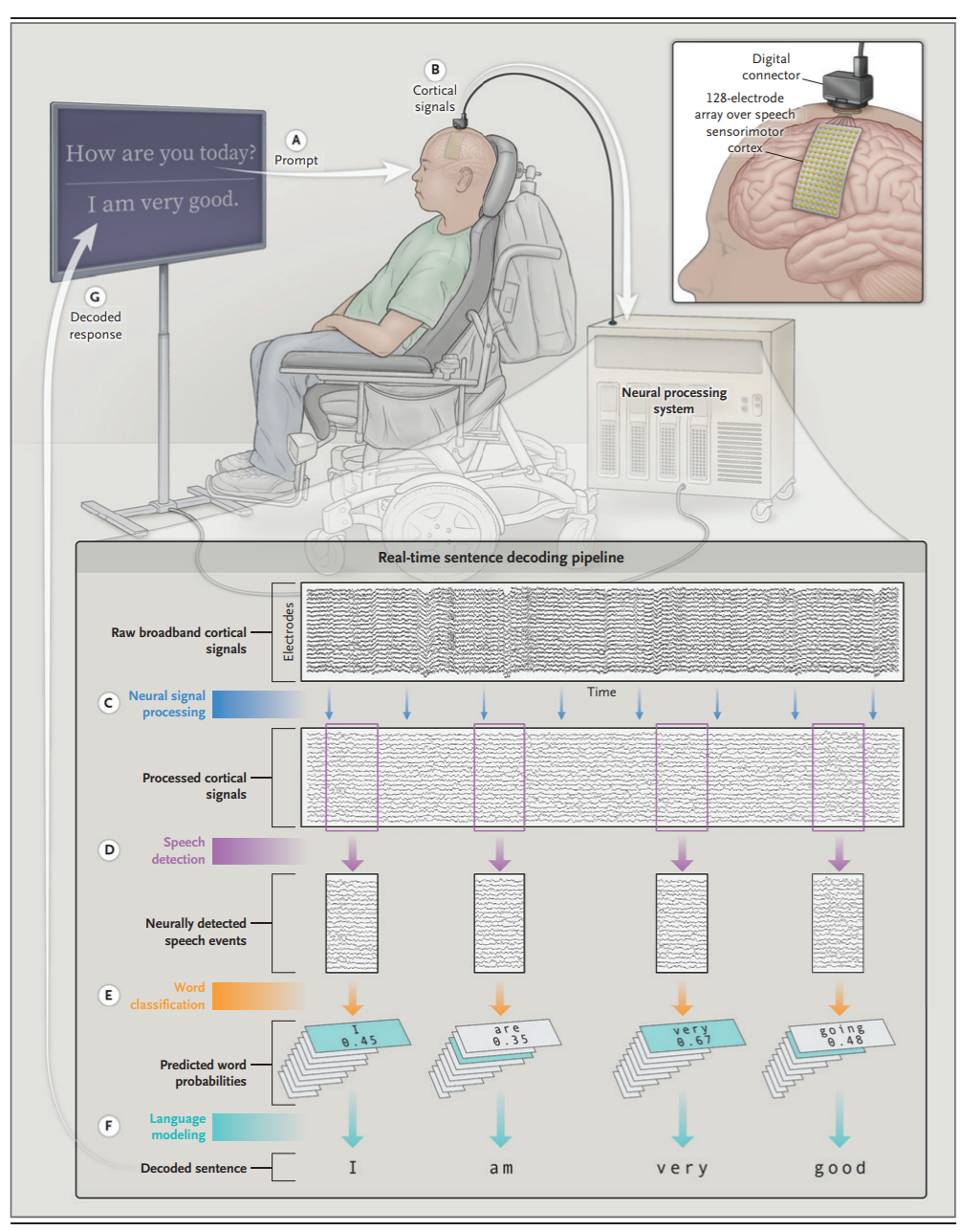 Brain Computer Interface for Decoding Speech in a Paralyzed Person ...