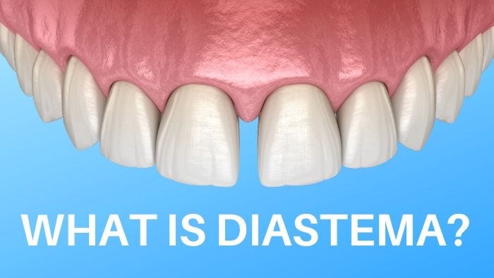 What is Diastema?. A gap between two teeth is otherwise… | by ...