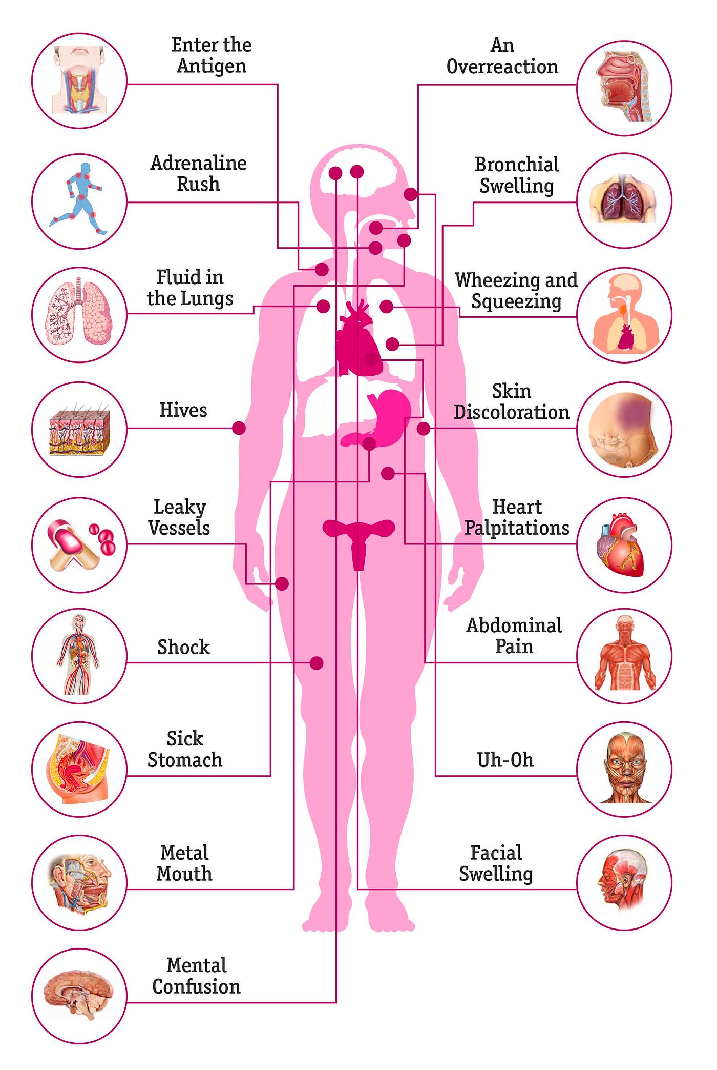 Anatomy of an Allergic Reaction: 6 Major Symptoms of Anaphylaxis | by ...
