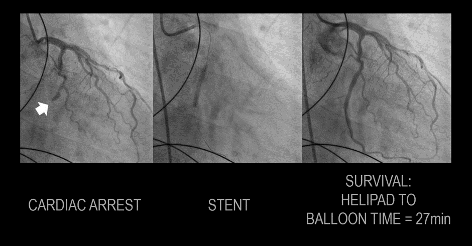 NHS PRIMARY ANGIOPLASTY FOR HEART ATTACKS : A MODEL FOR HEALTHCARE ...