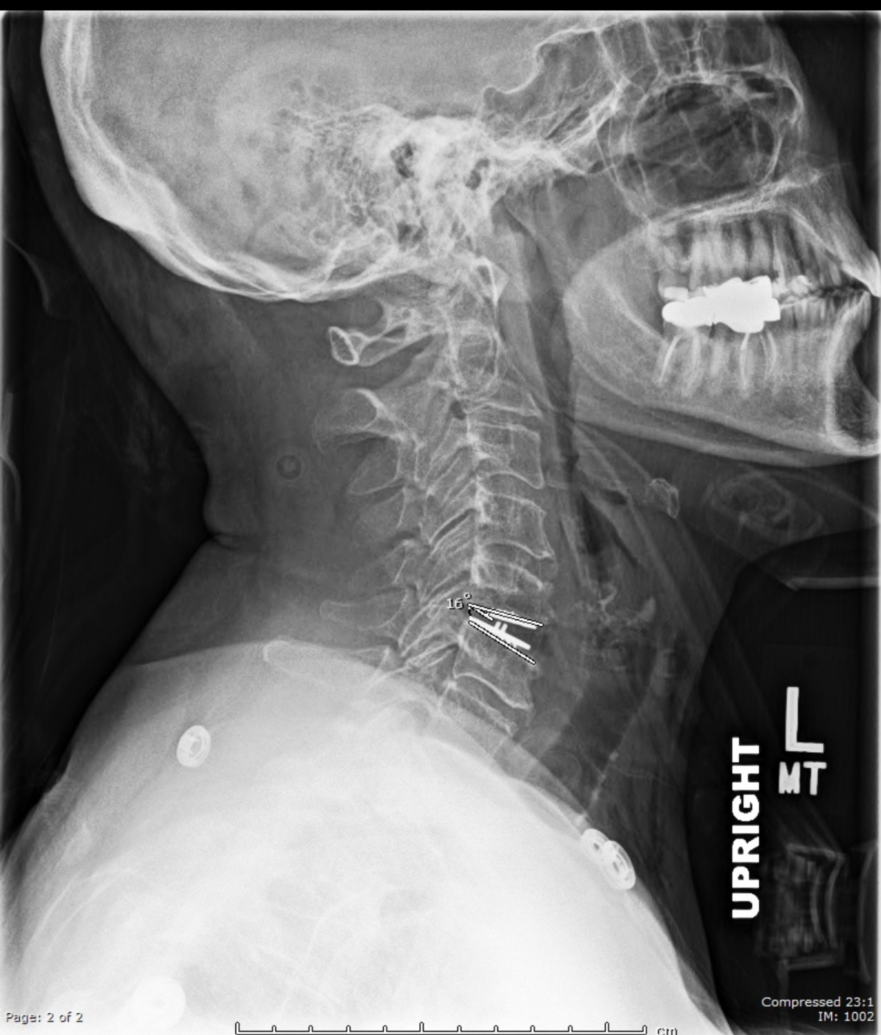 The era of minimally-disruptive spine surgery. Part 1: Failed Back ...