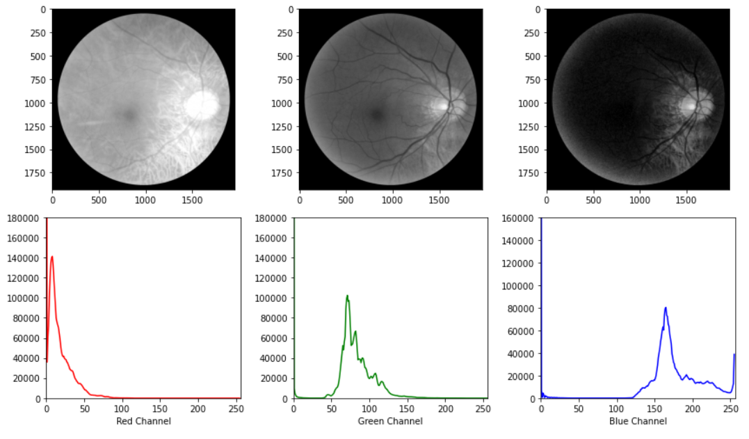 Cataract Detection Using Ml Lets Create An Ml Model To Classify An By Abhishek Selokar