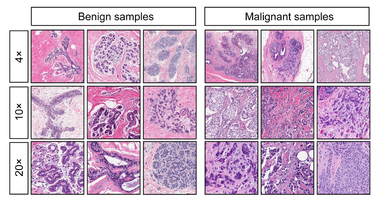 ⚕️ Breast Cancer Wisconsin [Diagnostic] - EDA 📊📈 | by Shubam Sumbria ...
