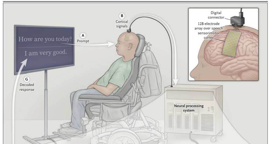 Brain Computer Interface for Decoding Speech in a Paralyzed Person ...