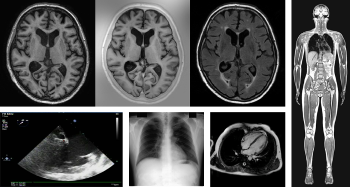 Abnormality Detection In Musculoskeletal Radiographs Using Deep Learning By Rohit Lokwani