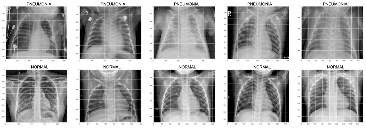 Pneumonia Detection From X-ray Images Using Deep Learning Neural ...