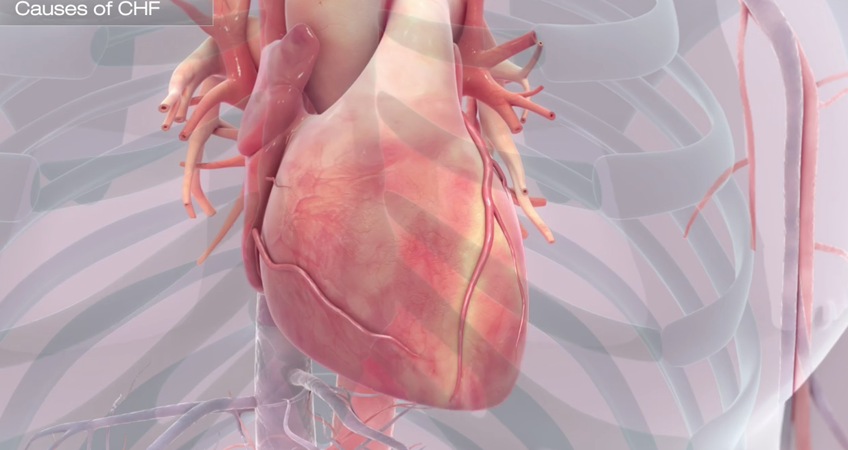 Explaining Congestive Heart Failure Using 3D Medical Animation | by ...