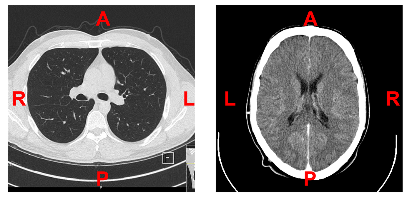 Understanding 3D medical image orientation for programmers | by Ashkan ...
