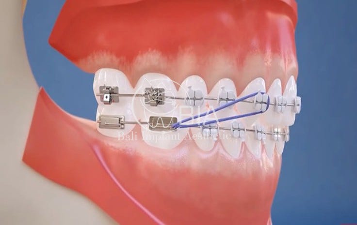 What You Should Know Before You Install Braces | by Bali Implant ...