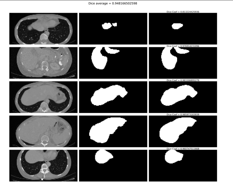 U-NET ConvNet for CT-Scan segmentation | by Fabio Sancinetti | Medium