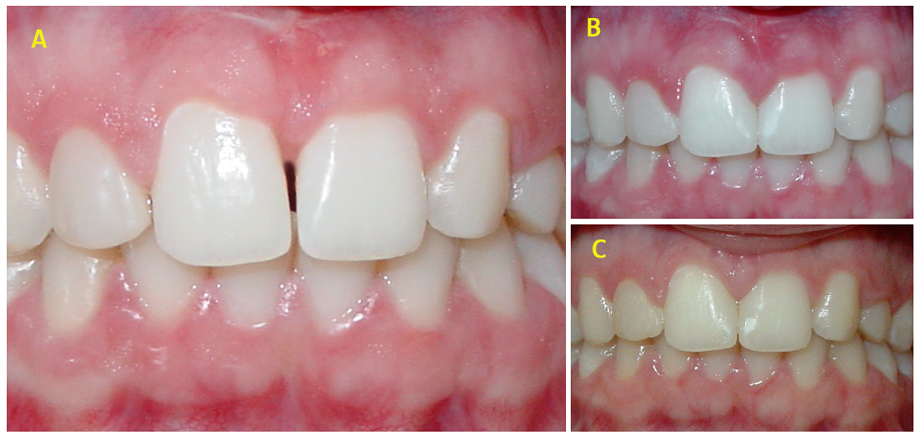 Diastema e Freio Labial Superior. As relações entre o Freio Labial ...