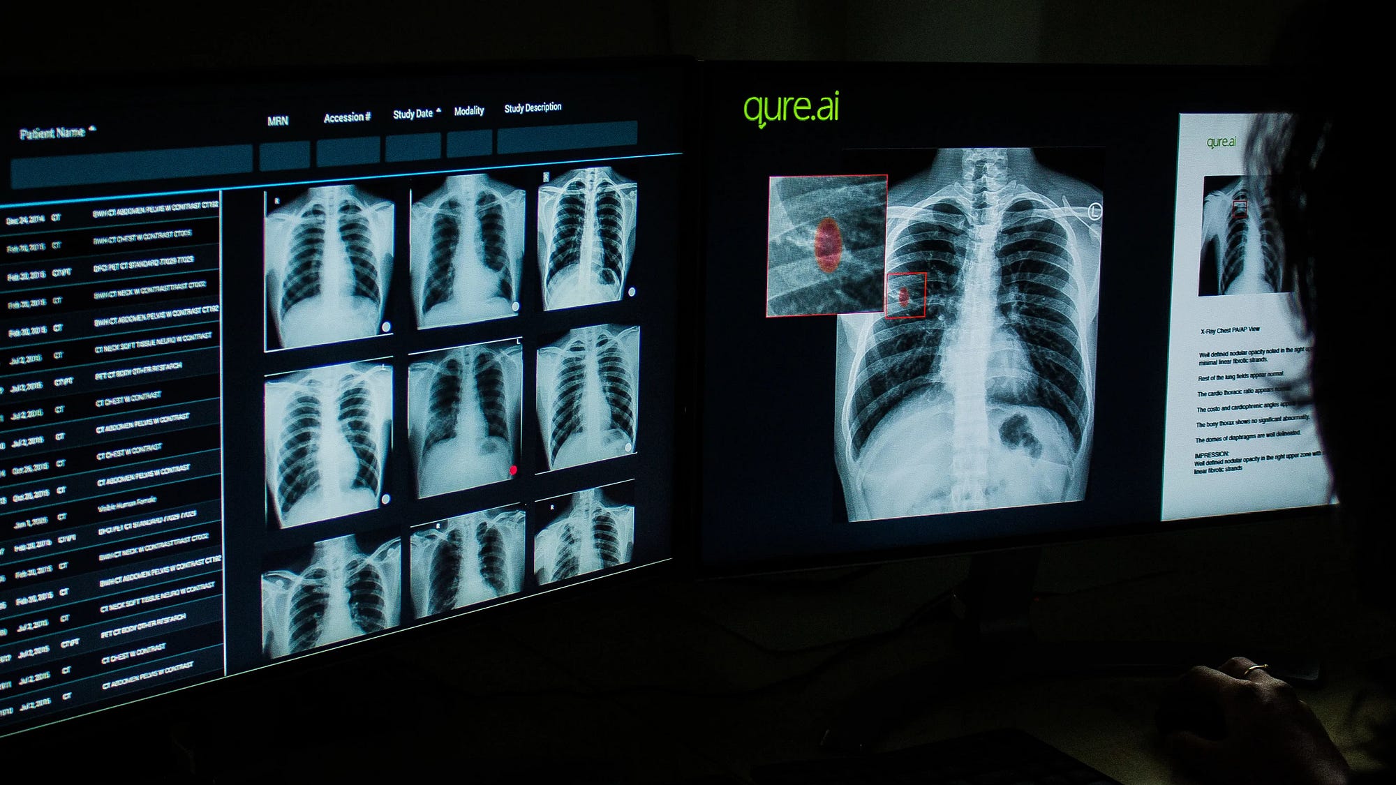 UBNet : Specific Convolution Neural Network Architecture for a Better ...