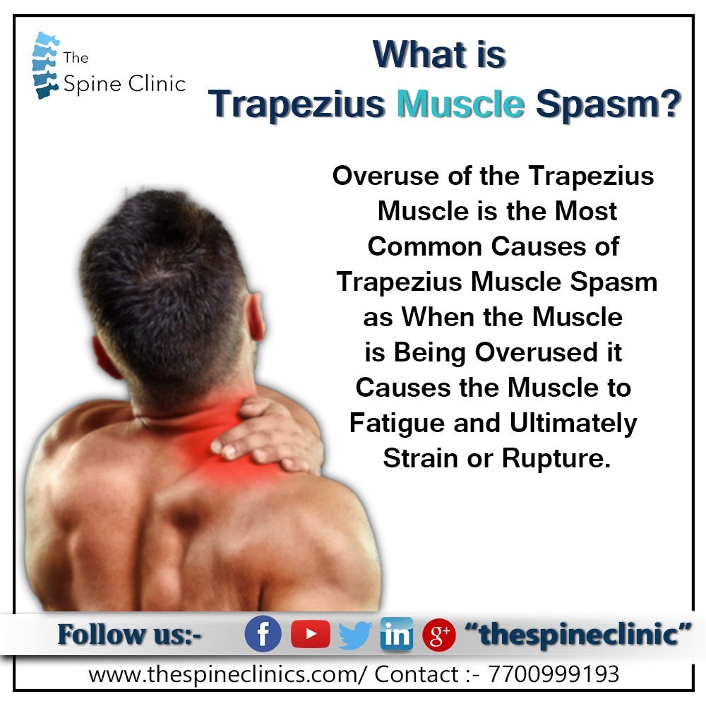 WHAT IS TRAPEZIUS MUSCLE SPASM The Spine Clinics Medium WHAT IS TRAPEZIUS MUSCLE SPASM The Spine Clinics Medium