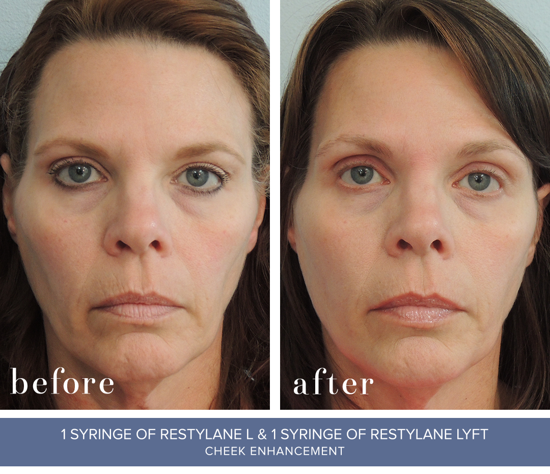 Restylane: A Quick Primer. The fastest way to answer your burning… | by ...