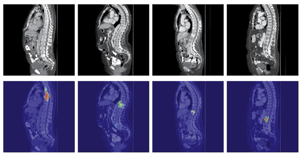 How Artificial Intelligence Can Now Detect Bone Fractures From Osteoporosis | by Jerry Wei ...