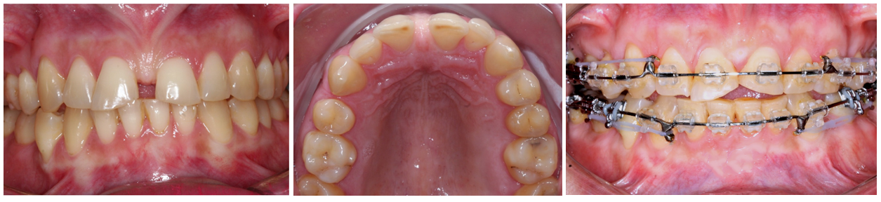 Diastema e Freio Labial Superior. As relações entre o Freio Labial ...