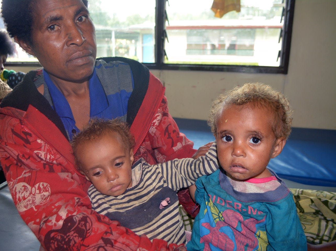 UNICEF supports prevention and treatment of severe acute malnutrition ...