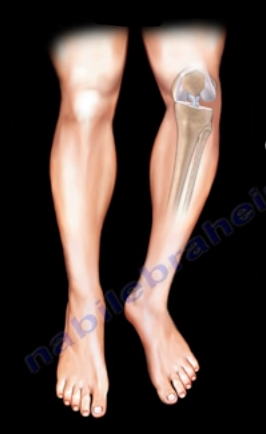 Valgus Knee Deformity. When the knee is not perfectly aligned… | by ...