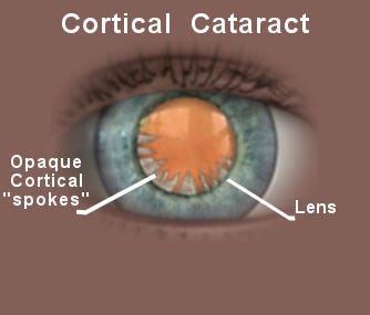 Types of cataracts include. 1.A subcapsular cataract :occurs at the ...