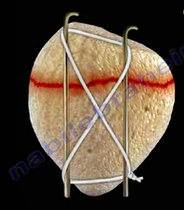 Patellar Fractures. Basic anatomy for the knee includes the… | by Nabil ...