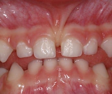 Removal of high frenum. Frenum is a fold of soft tissue which… | by ...