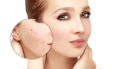 TCA As A Skin Peeling Agent In Chemical Peel Treatment | by Molan ...