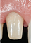 All you need to know about Vertical Preparations - ConfiDent - Medium