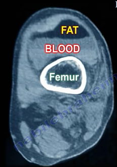 Hemarthrosis of the Knee. Hemarthrosis is blood inside the knee… | by ...