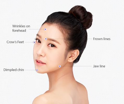 Otot Disuntik Botox Aman Dari Bedah Plastik Wonjin Korea | by vini lina ...