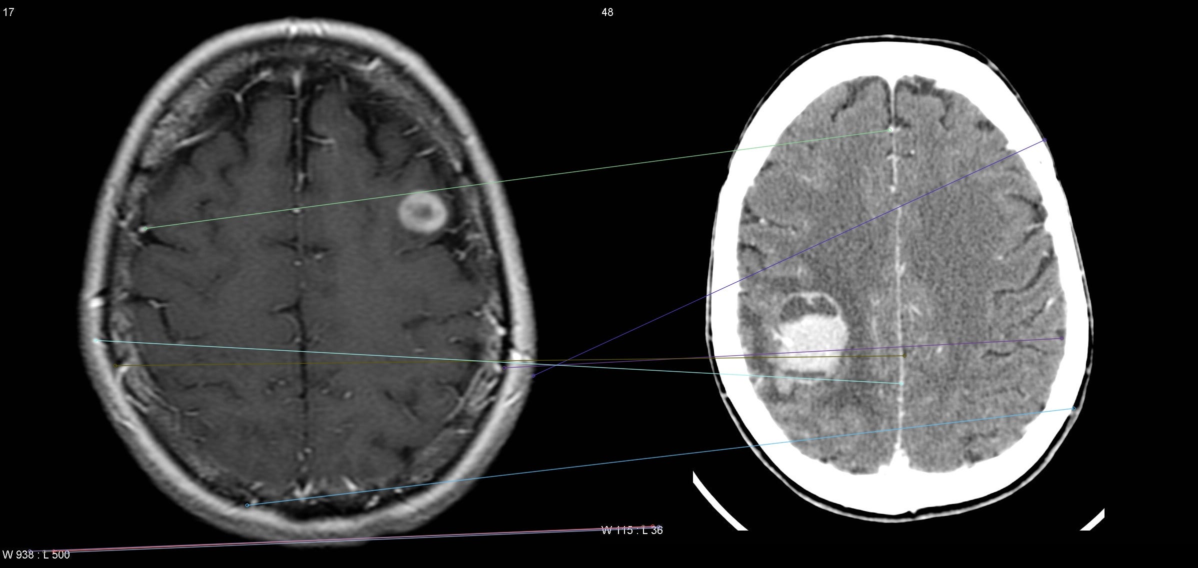 Robodoc Using Machine Learning To Detect Brain Tumors By Jose Analytics Vidhya Medium