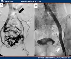 Iliofemoral Vein Stenosis — A Narrowing of Major Veins in the Legs | by ...