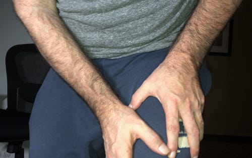 Meralgia Paresthetica Symptoms, Causes, Diagnosis, and Treatment | by ...