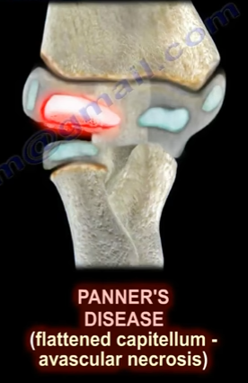 Panner’s Disease. Panner’s Disease is a pathology… | by Nabil Ebraheim ...