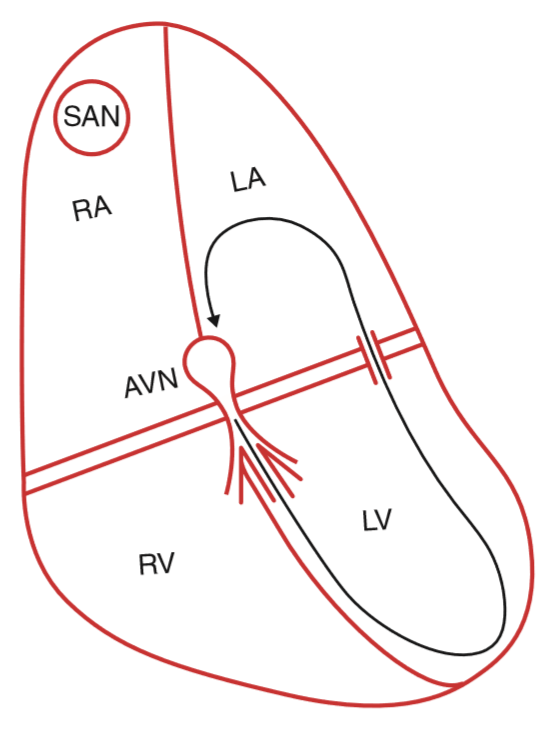 Supraventricular Tachyarrhythmias: An Overview | by Nandan Tumu ...
