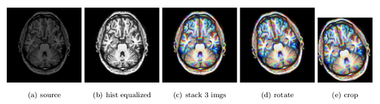Brain MRI Segmentation using Deep Learning | by Abhijeet Khangarot ...