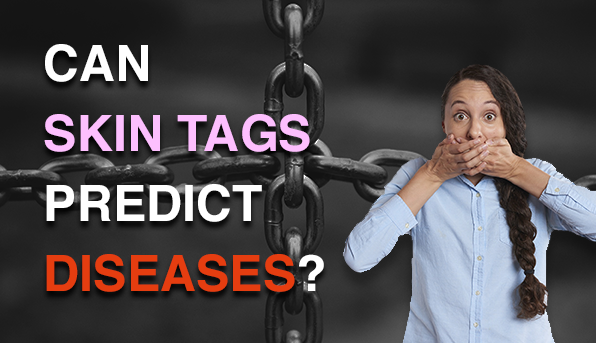 People With Skin Tags May Unknowingly Have One of These Diseases | by ...