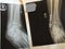 Tips for Surviving a Broken Ankle - Leela Shona - Medium