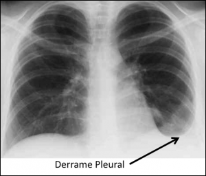 Funções e Doenças das Pleuras. Assim como diversos órgãos do corpo ...