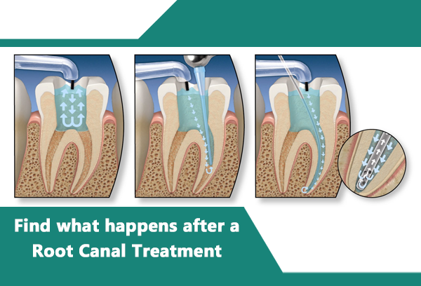 Extend the Life Of Your Decayed Tooth With Dental Root Canal Treatment ...
