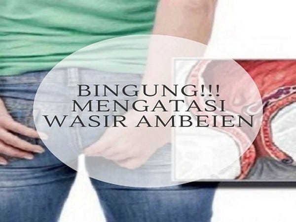 Cara Mengecilkan Benjolan Wasir Luar | by Cara Mengatasi Wasir Secara Alami | Medium