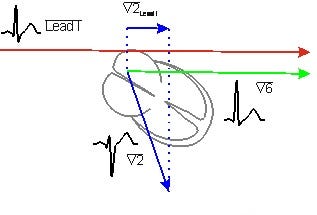 Single lead ECG informativity for wearable application. | by Tim Lipski ...