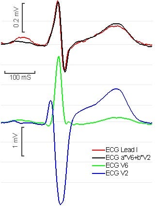 Single lead ECG informativity for wearable application. | by Tim Lipski ...