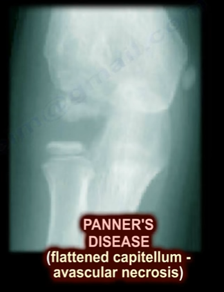 Panner’s Disease. Panner’s Disease is a pathology… | by Nabil Ebraheim ...