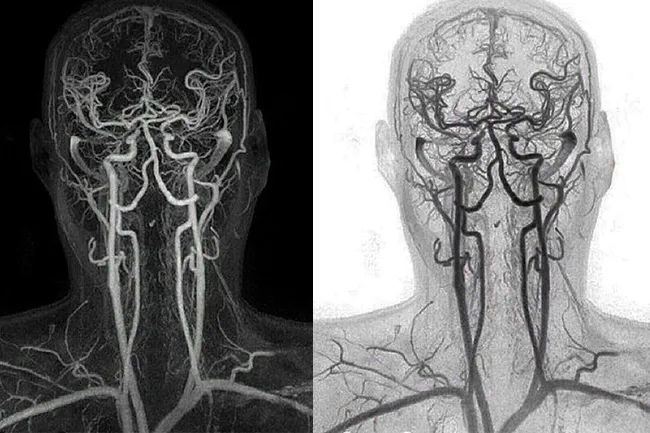 3d Vascular Segmentation Using Deep Learning By Cerebra Medium
