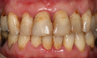 Discoloured Front Tooth. The causes of a Discoloured Front Tooth… | by ...