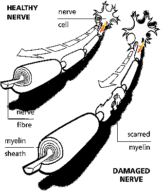 Repairing Myelin to Address Neurological Symptoms of Disease | by ...