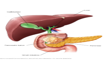 A BRIEF AWARENESS ABOUT THE PANCREATIC CANCER: A BIOGIANT OF THE ...