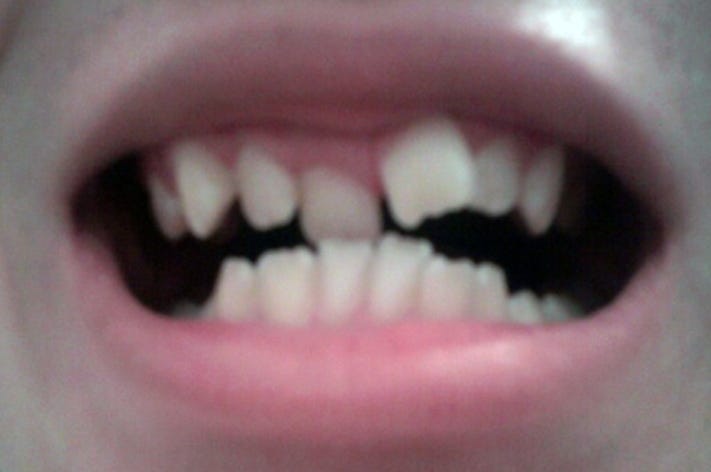 How To Save Thousands On Braces And Get a Beautiful Hollywood Smile ...