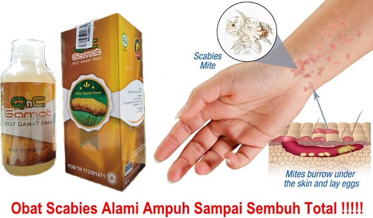 Obat Scabies Alami Ampuh Sampai Sembuh Total | by Anjasmara | Medium