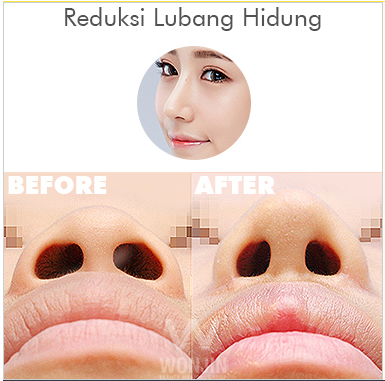 Permak Hidung Besar dengan Operasi Plastik Hidung Korea | by Vee | Medium